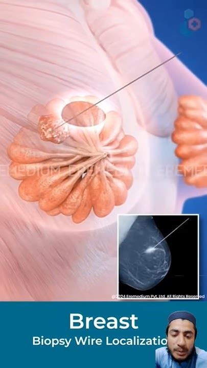 Breast Biopsy With Wire Localization Step By Step Guide For Patients