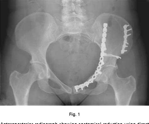 Figure From Outcomes Of Acetabular Fracture Fixation With Ten Years Follow Up Semantic Scholar