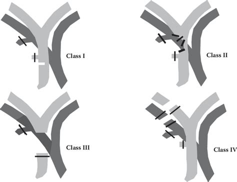 2 Stewart Way Classification Of Laparoscopic Bile Duct Injuries Download Scientific Diagram 2 Stewart Way Classification Of Laparoscopic Bile Duct Injuries Download Scientific Diagram