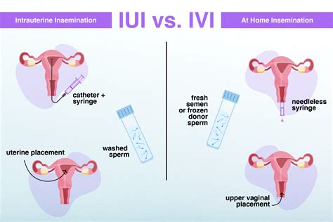 iui process at home - Julia Cameron