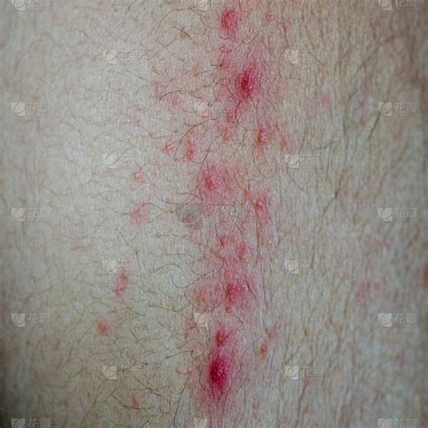 过敏性皮疹、皮炎、湿疹皮肤