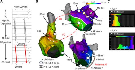 Atypical Form Of Biatrial Tachycardia Using An Interatrial Connection