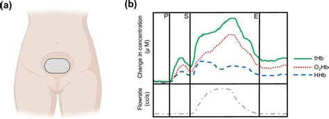 A Location Of A Nirs Device For Transcutaneous Bladder Monitoring