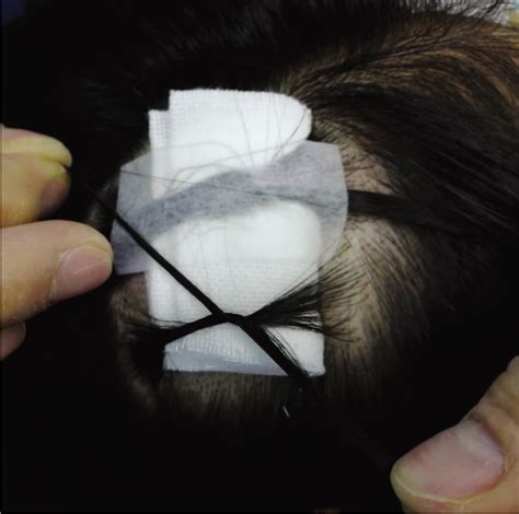 Cross Fixation Bandage With Long Hair On Scalp Wound After Surgery Indian Journal Of