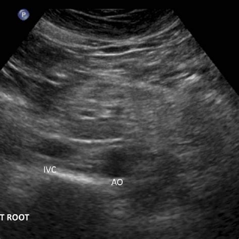 Transverse Us Echogenic Preaortic Precava Pseudomass With Anterior Download Scientific Diagram
