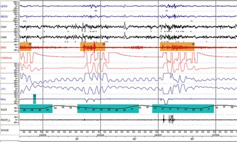 Polysomnography An Overview Springerlink