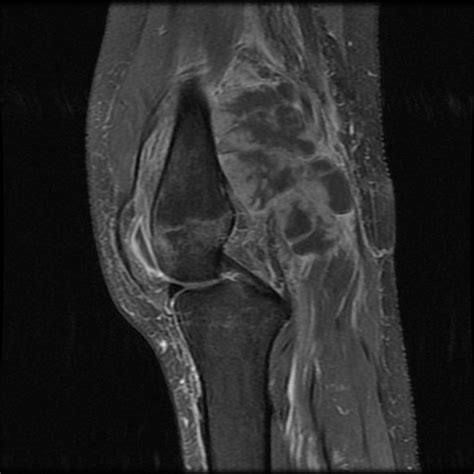 Extraskeletal Ewing Sarcoma Pacs