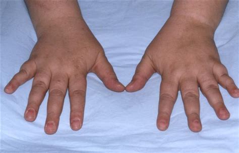 Pseudohypoparathyroidism Basic Science Orthobullets