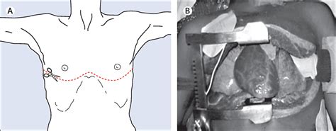 Clamshell Thoracotomy Icd 10 At Joan Byrd Blog
