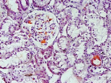 Congo Red Stain Shows Accumulation Of Amyloid In The Mesangial Areas