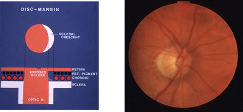 Choroidal Crescent Vs Scleral Crescent