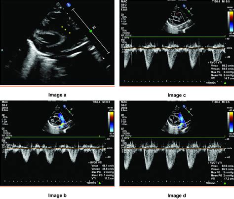 Measurement Of Vti At Different Locations Along The Rvot A Shows Vti Download Scientific Measurement Of Vti At Different Locations Along The Rvot A Shows Vti Download Scientific