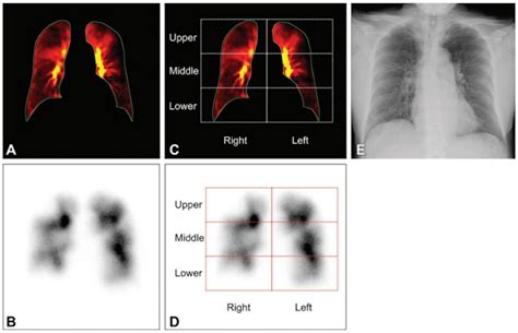 Dynamic Chest Radiography A Viable Way To Diagnose Lung Hypertension