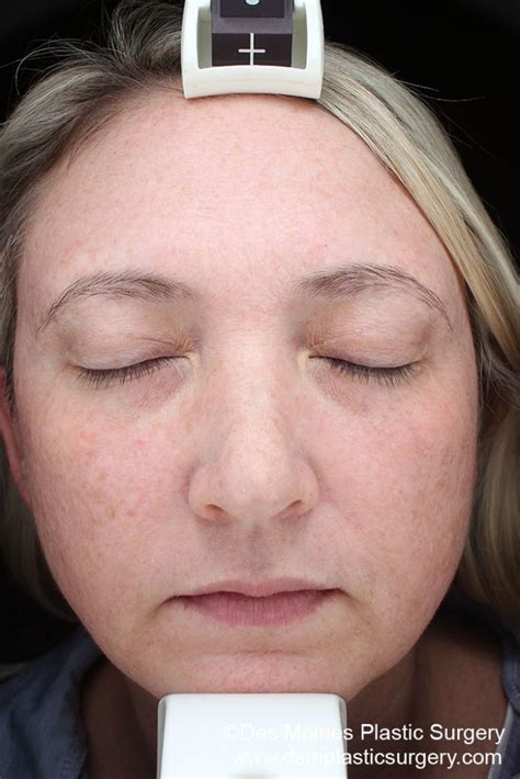 Moxi Before After Gallery Coachlight Clinic Spa