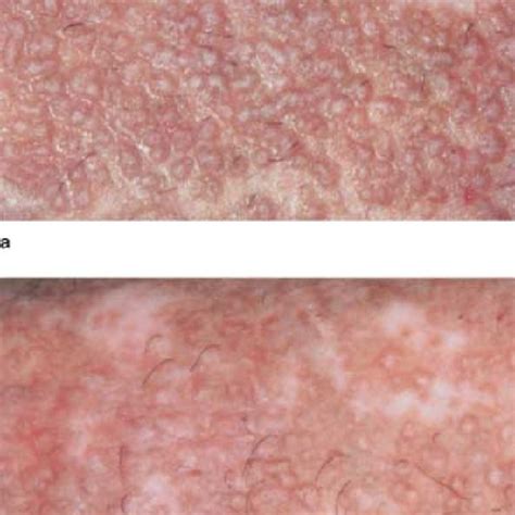 Diffuse Dermal Infiltrate Of Epithelioid Cells Macrophages Plasma Download Scientific Diagram