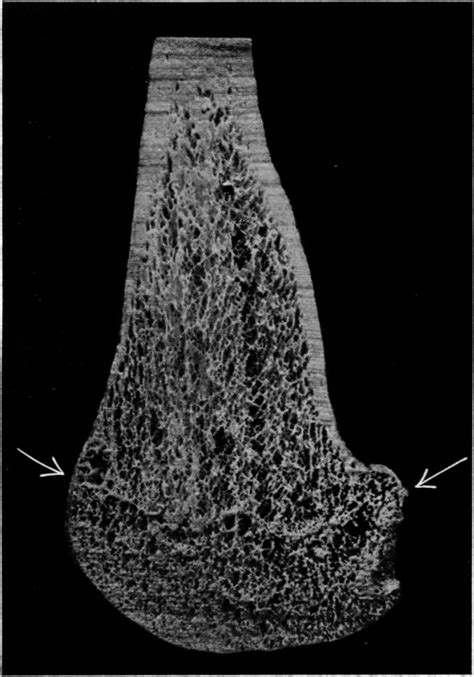 Fusion Lines Of Bones Abstract Europe Pmc