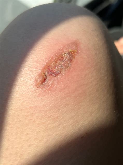 화상 상처 부위 곪음 지식in