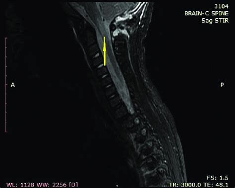 Post Operative Magnetic Resonance Imaging Mri Sagittal Short Tau