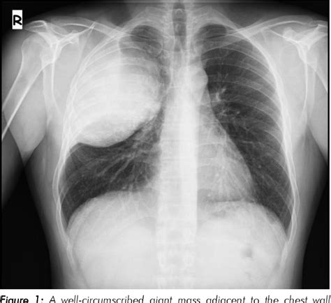 Figure 1 From A Case Of Primary Pleural Synovial Sarcoma Primer