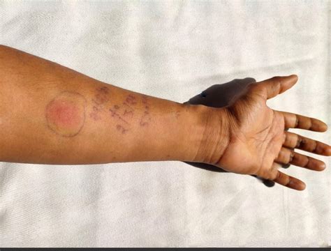 Hypersensitivity 4 Types Based On The Gell And Coombs Classification The Immune System Explainer