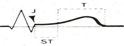 Electrocardiogram Flashcards Quizlet