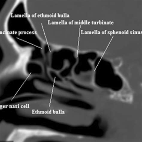 Keros Classification [15] Of The Height Of The Olfactory Fossa A Type Download Scientific