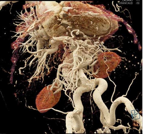 Bypass Grafting To The Superior Mesenteric Artery Sma Vascular Case