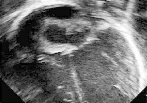2d Echocardiography With Apical Four‑chamber View Showing The