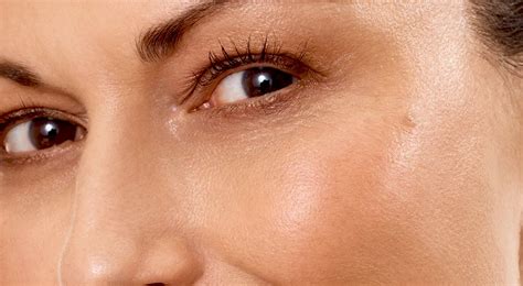 Acne Scar Treatments Discover The Most Effective Solutions Today