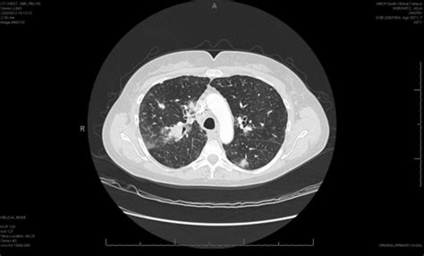 Fcm Pulmonary Sarcoidosis Cf Bronchiactesis Lecture Flashcards Quizlet