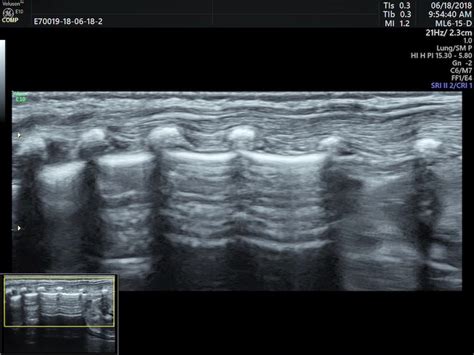 Protocol And Guidelines For Point Of Care Lung Ultrasound In Diagnosing Neonatal Pulmonary