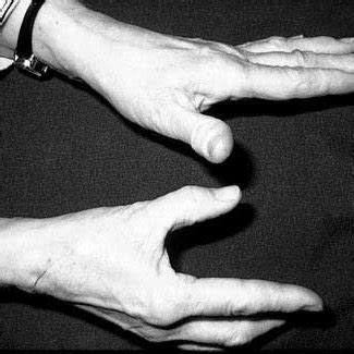 Technique Of EIP To EPL Transfer Showing The EIP Being Advanced Download Scientific Diagram