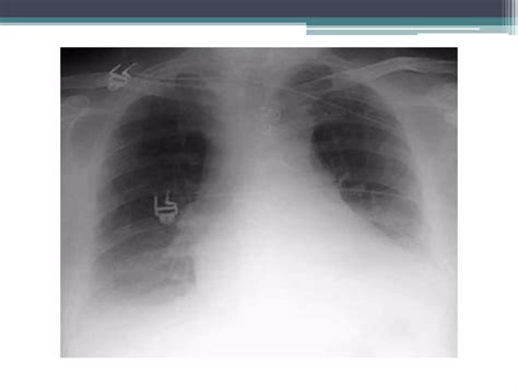 Chest X Ray Positioning Pptx