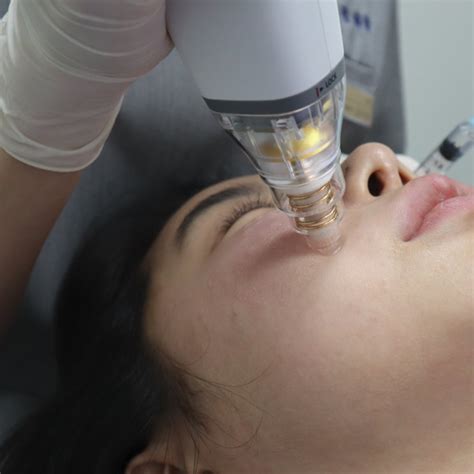 강남 포텐자 레이저 비용 펌핑팁 Cp 21 을 활용한 복합 시술 안내 네이버 블로그