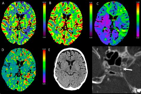 color coded maps generated from computed tomography perfusion ctp of