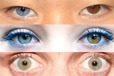 Heterochromia Eyes Nhs
