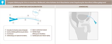 Suprapubischer Blasenkatheter Für Senioren Qoibyx