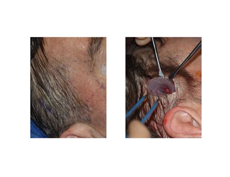 Technical Strategies Extended Temporal Implants Explore Plastic Surgery