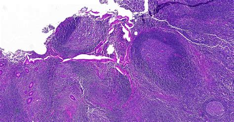 Pathology Outlines Lymphoid Hyperplasia