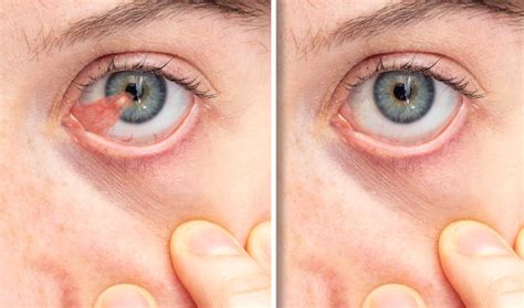 Pinguecula Vs Pterygium Radhika Rampat Ophthalmology