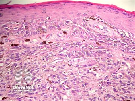 Malignant Melanoma In Situ Histology