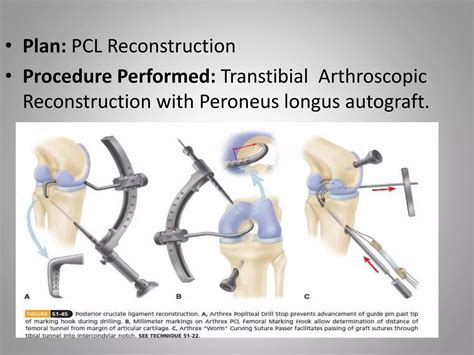 Arthroscopic Pcl Reconstruction Pptx