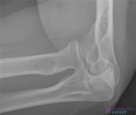 Elbow Xray Anatomy Radiopaedia