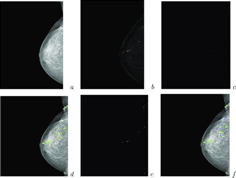 single microcalcification detection a original image b