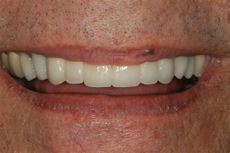 Porcelain Crowns And Bridges Smile Gallery Tysons Aesthetic Dentistry