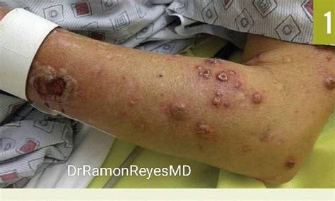 Ems Solutions International Infección Por Pseudomonas Aeruginosa
