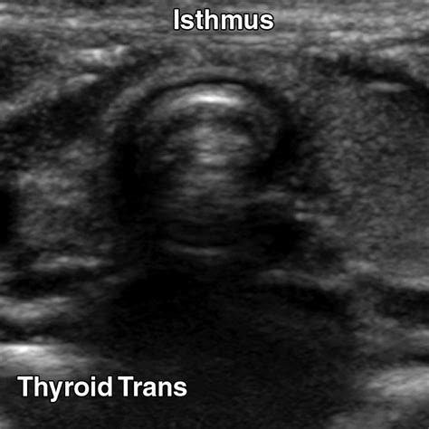 Hypothyroidism Thyroid Ultrasound Thyroid Gland Radiology Key