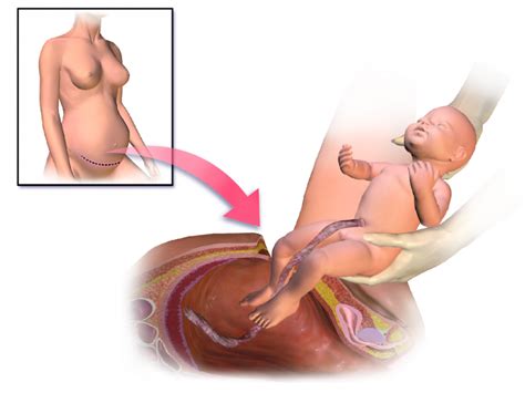 Cesarean Birth When Is A Cesarean Section Necessary Dr Rhythm Gupta