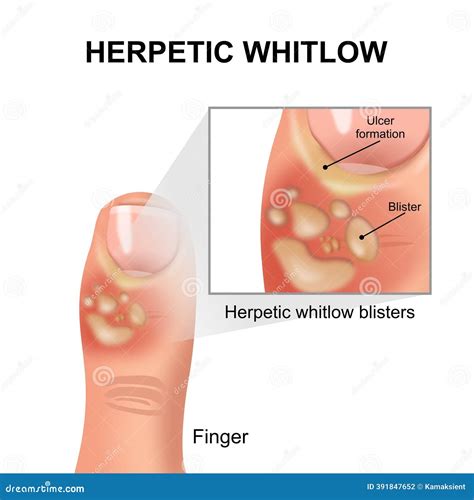 Whitlow Vector Illustration 70189506