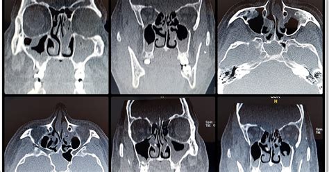 We Performed Nasal Polypectomy And Functional Endoscopic Sinus Surgery
